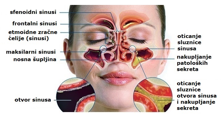 Bolesti nosne šupljine i paranazalnih sinusa